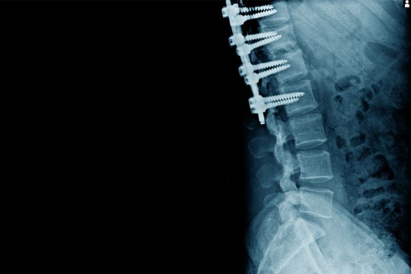 Spinal Fusion Surgery at Anatolian Health: Bridging Stability and ...
